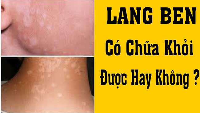 Bệnh lang ben có chữa khỏi được không?